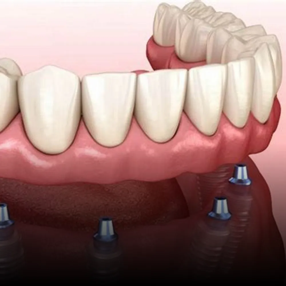 Full Mouth Reconstruction – Spire Dental